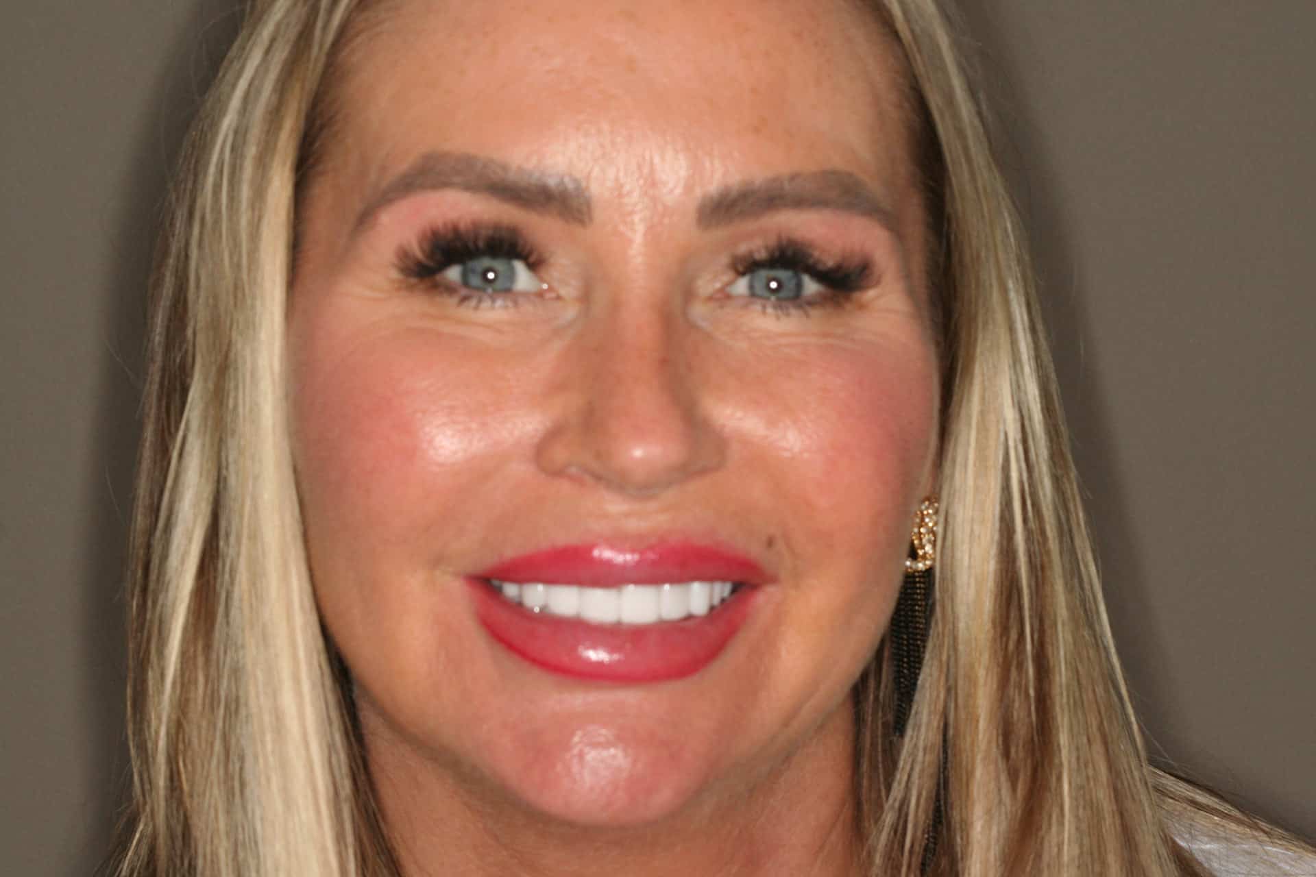 Perfect Smile Makeover: Veneers & Crowns