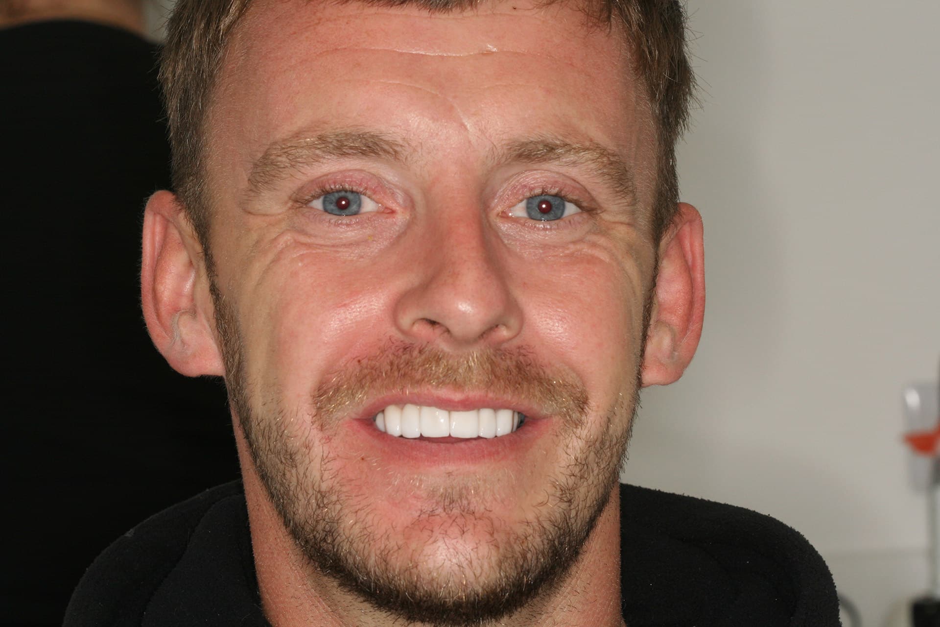 Porcelain Veneers for Worn Teeth | Oliver Cosmetic Dental Clinic